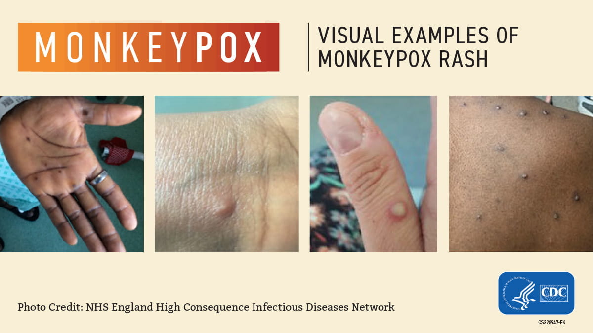 New Monkeypox Vaccination Guidelines - Golden Rule Services